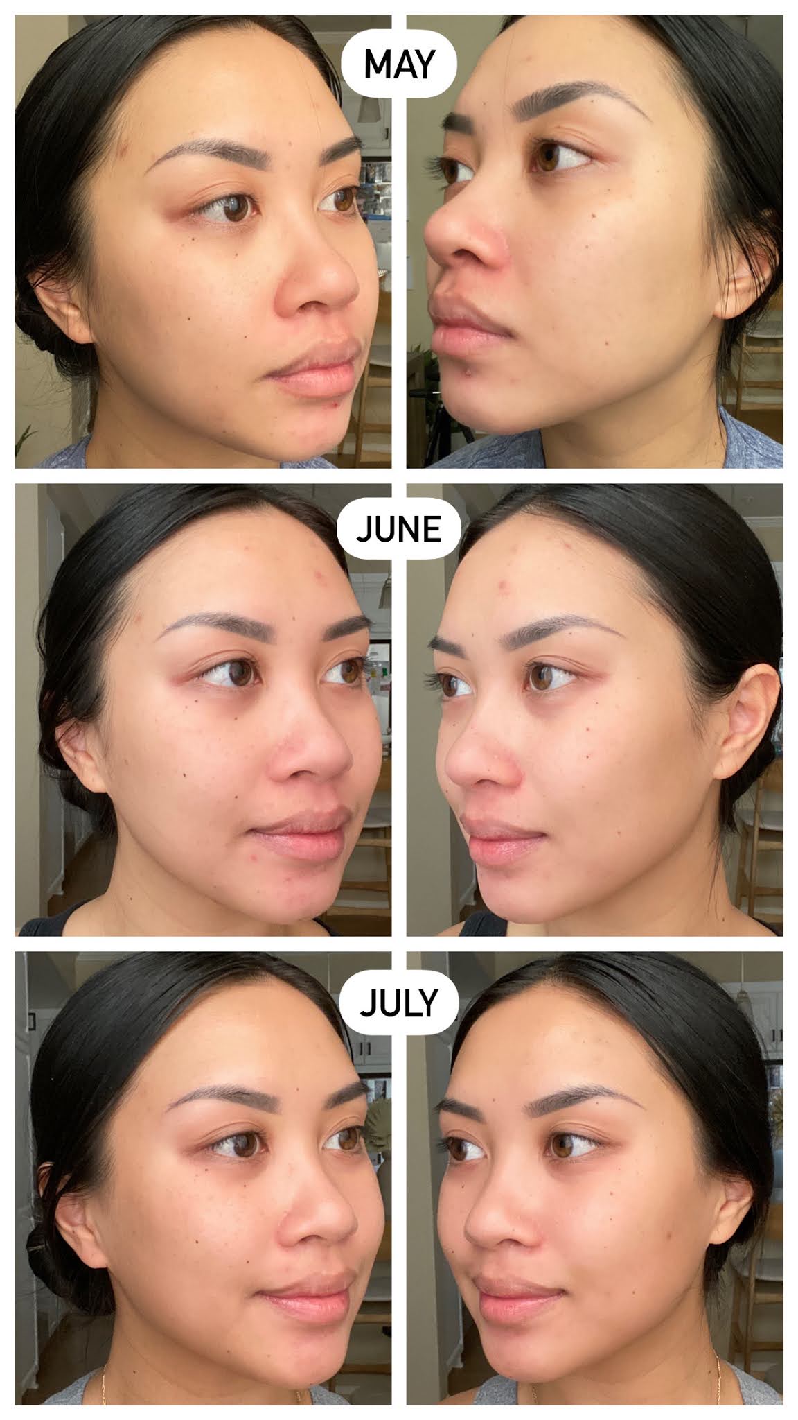 Healthy-ish: My Current Skincare Routine + Acne Progress Photos!