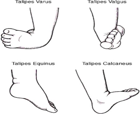 RSOP Melayani Pengobatan Kaki Pengkor atau CTEV (Congenital Talipes ...