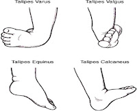 RSOP Melayani Pengobatan Kaki Pengkor atau CTEV (Congenital Talipes ...
