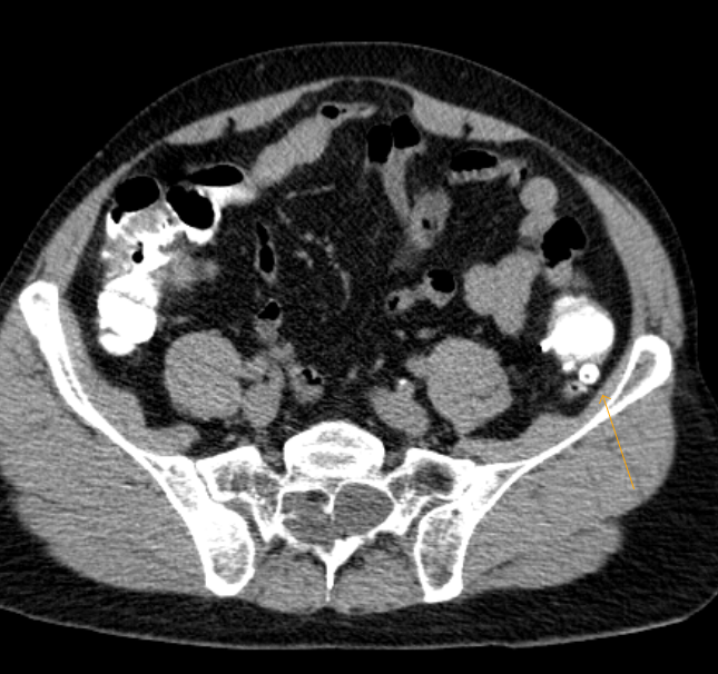 Diverticulitis- CT - Sumer's Radiology Blog