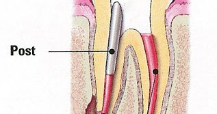 Treatment with Post & Core - Healthy Dent