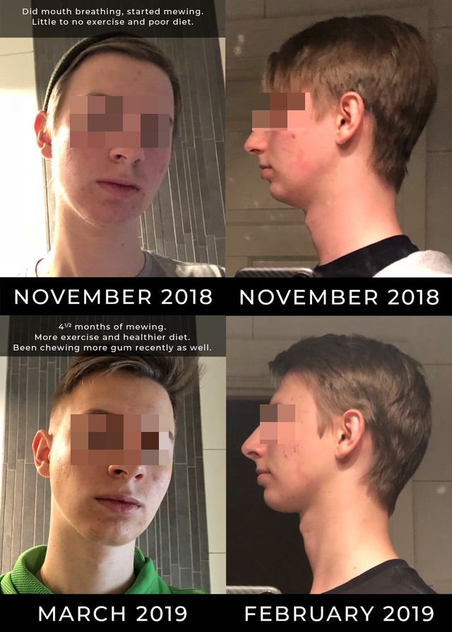 Những điều bạn cần biết về mewing ~ The beausty