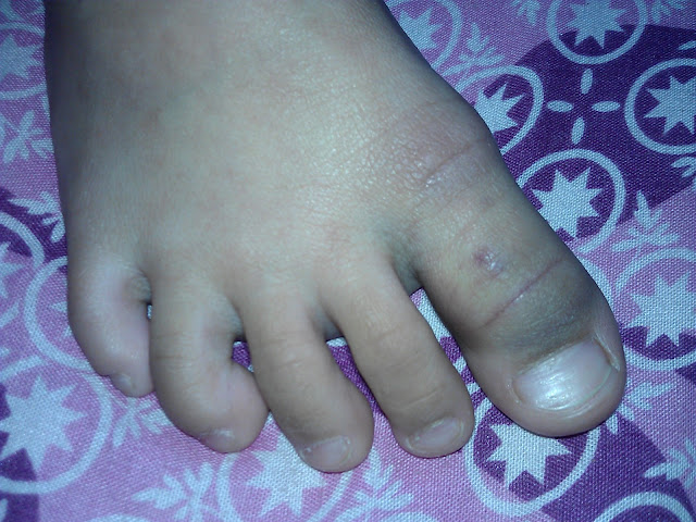 The Journey Of My Life @--: Lebam Biru Ibu Jari Kaki Kanan Anakku