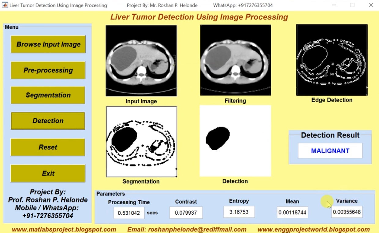Matlab Code For Liver Tumor Detection Using Image Processing