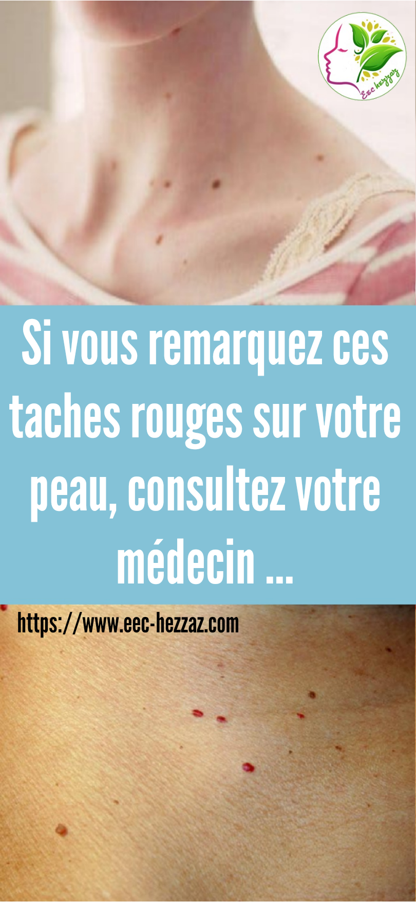 Si vous remarquez ces taches rouges sur votre peau, consultez votre ...