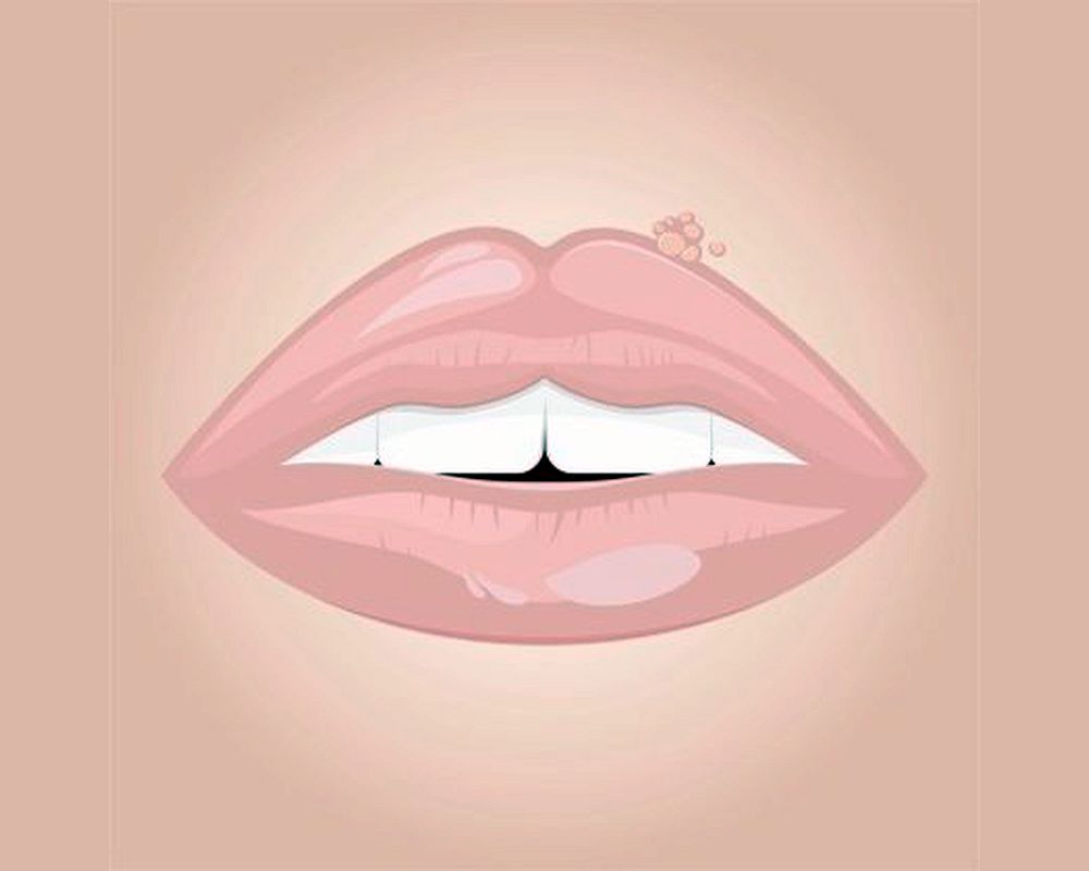 Herpes labial y Candidiasis oral: ¿Cómo detectarlas? - OdontoVida