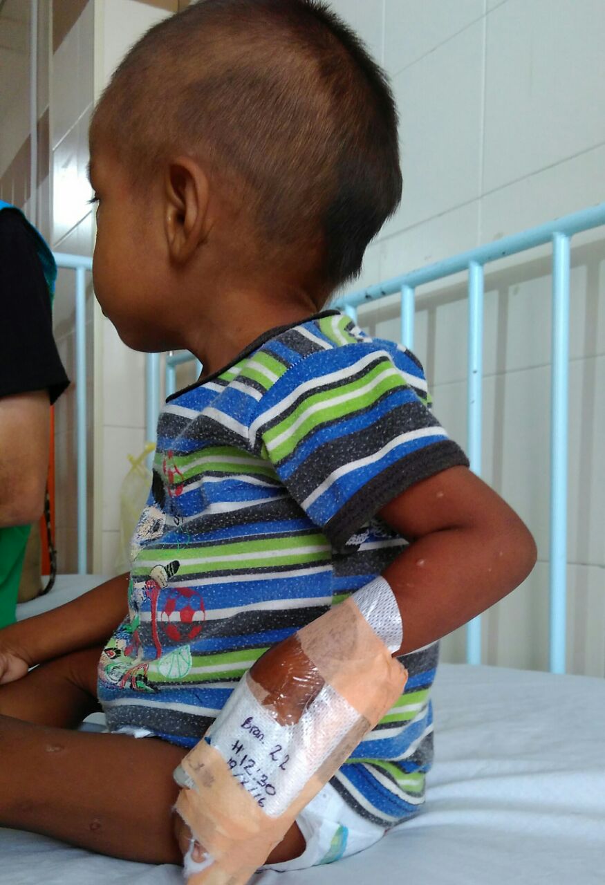 En el Hospital de Riohacha se recupera niño con desnutrición, remitido ...