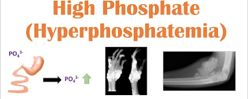 Ayurvedic Cure Of Hyperphosphatemia
