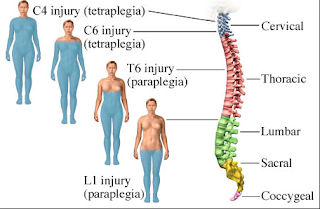 Spinal Cord Injury Causes , Symptoms ,Diagnosis and Treatment: Types of ...