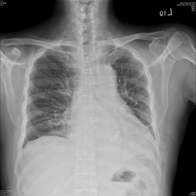 淨元法師之大醫院小醫師: Aortic annulus abscess s/p pericardial patch + AVR
