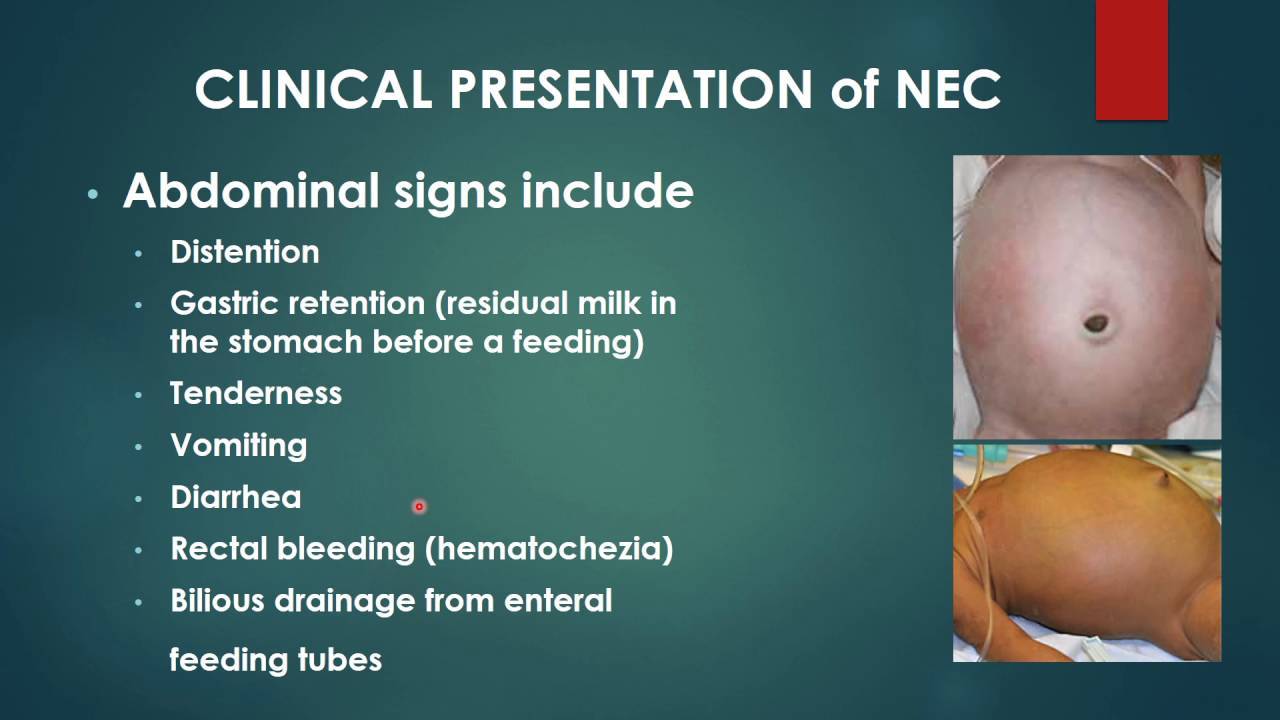 Necrotizing enterocolitis
