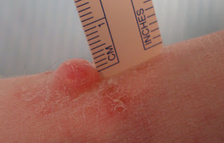 VIRTUAL GRAND ROUNDS IN DERMATOLOGY 2.0: Superficial Acral Fibromyxoma