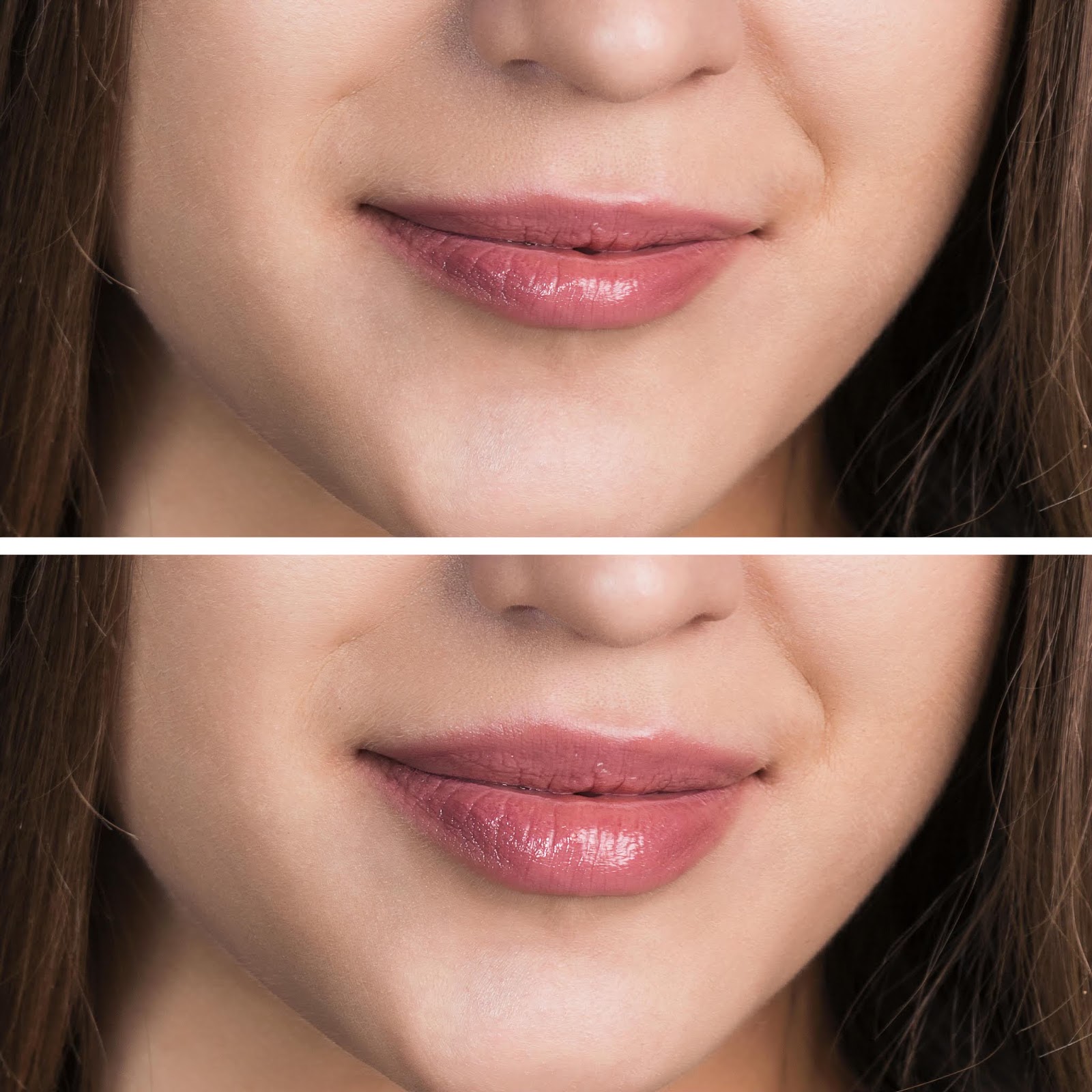 Aesthetics by Silvie: Lip Dermal Filler & Smile Enhancements