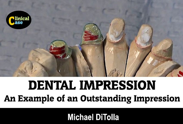 DENTAL IMPRESSION: An Example of an Outstanding Impression - Michael ...
