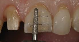 Clinical failure of the amalgam restoration usually occurs from ...