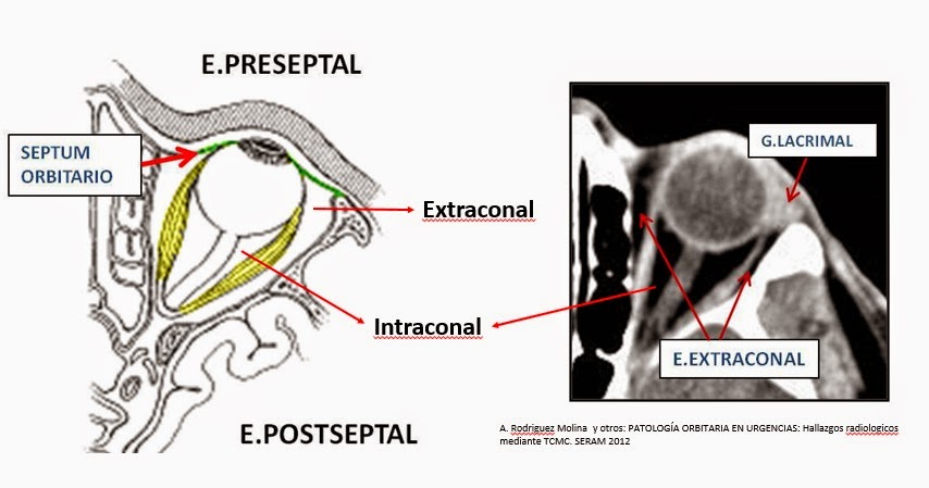 ESPE 202 - 2014: Anatomía y patologías de la cavidad orbitaria