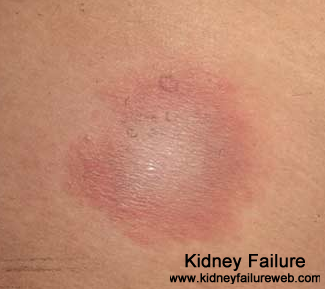 kidney expert: The Causes and Treatment for Kidney Failure Patients ...