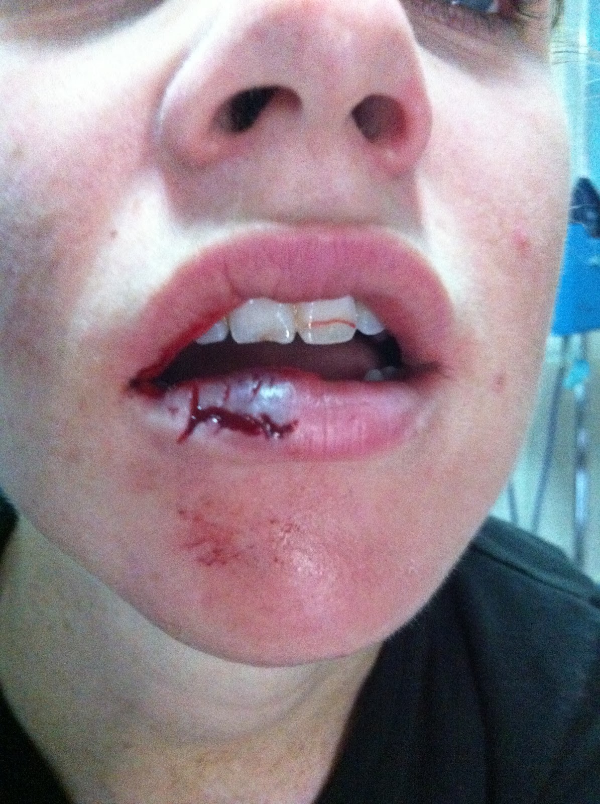 Amber's Alerts From Life in Haiti: Snitches get Stitches