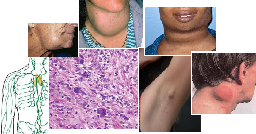 What Is Hodgkins Lymphoma In Cancer