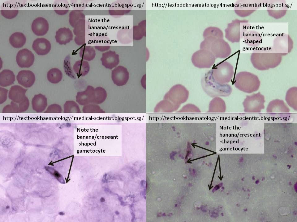 Haematology in a NutShell: Plasmodium Falciparum in Thick and Thin Films