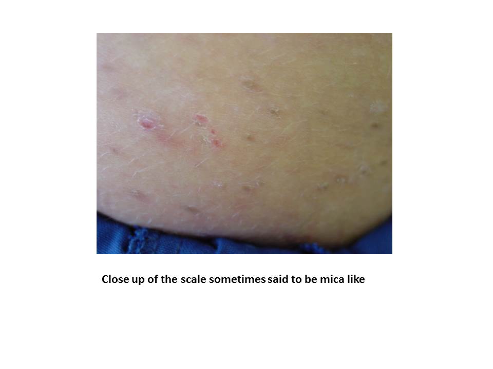 Consultations in Dermatology: Pityriasis Lichenoides PLEVA