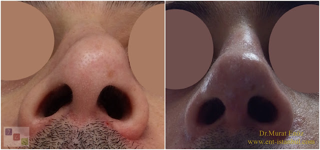 Rhinoplasty Operation For Crooked Nose