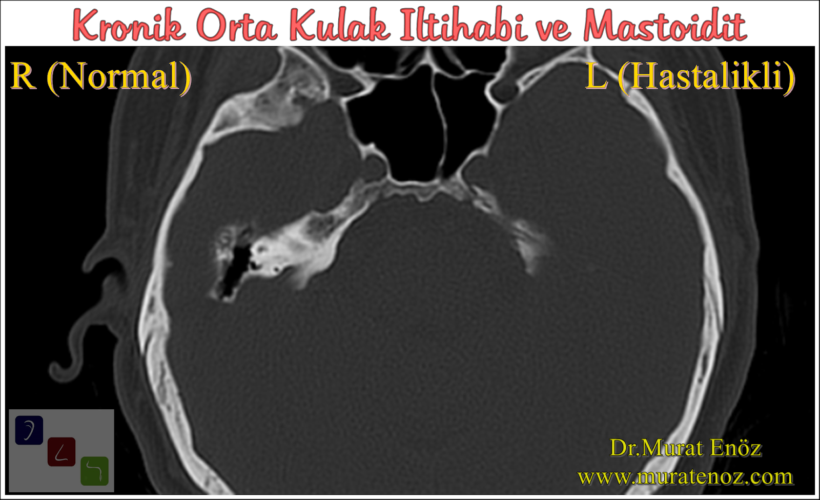 Kronik Orta Kulak İltihabı ve Mastoidit
