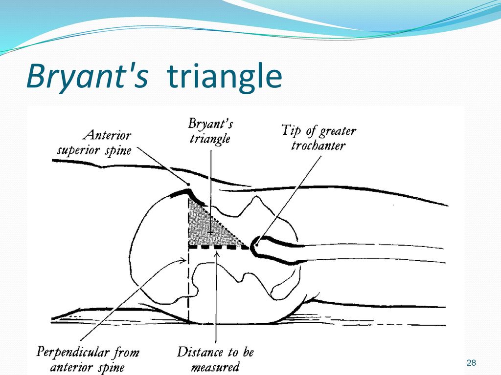Med4yu: Unequal leg lengths : Limb Length Discrepancy