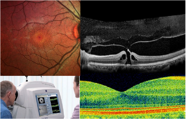 Retina e Catarata - Fortaleza: OCT Macula e nervo óptico