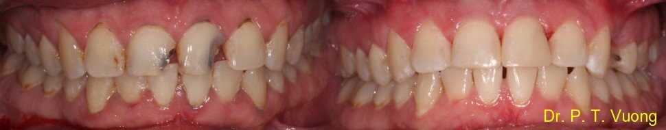 Cavities In Front Teeth