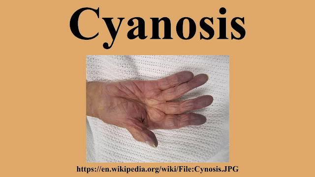 Cyanosis