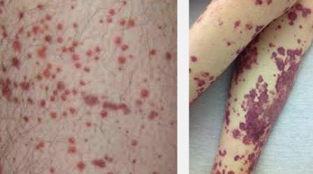 KENALI CIRI-CIRI PENYAKIT DEMAM BERDARAH