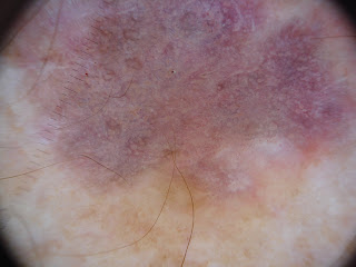 Consultations in Dermatoscopy: Pink and Purple