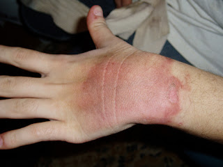 learn nursing: Definition and causes burns and how to deal with it.