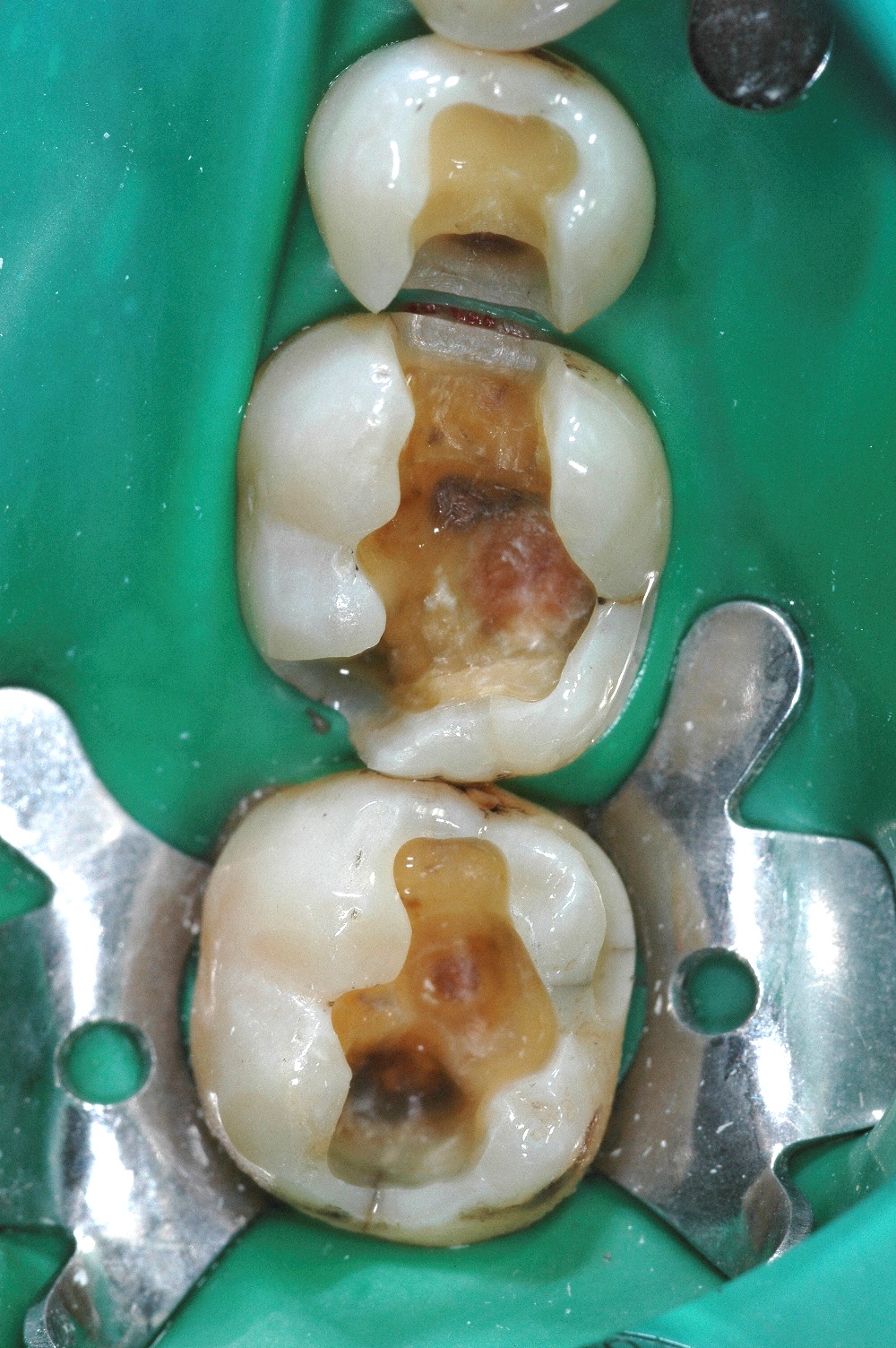 Hai la dentist: Carii dentare