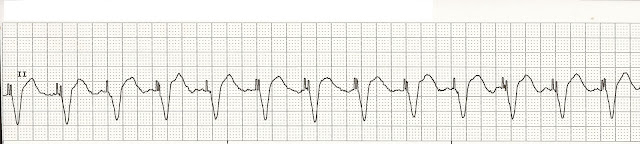 EKG Rhythm Strips 71