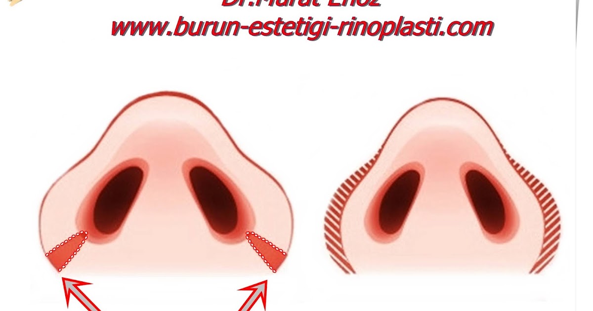 Health Zone Turkey: Nose Wing and Nasal Holes Shrinkage Surgery: Alar ...