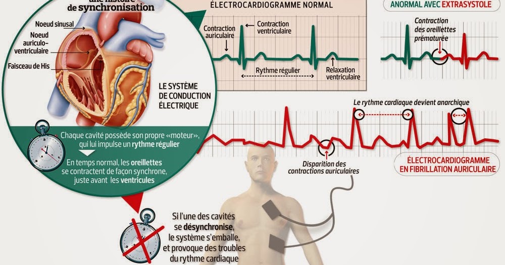 Blog 75: Infos santé-Troubles du rythme cardiaque
