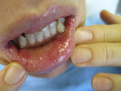 Dermatology For Dentists and Dental Students: Oral Medicine for Dental ...