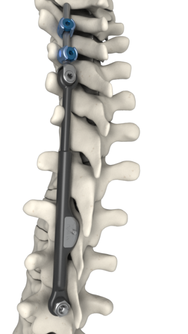 ApiFix MID-C | Growing Spine Blog | Washington University in St. Louis