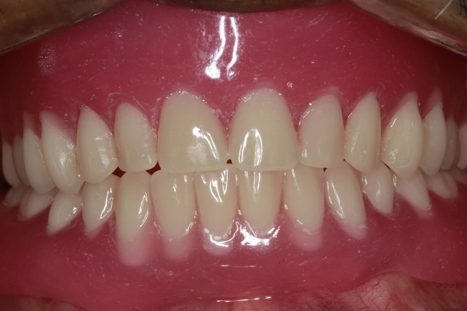 Understanding Prosthodontics - Tagore Dental College & Hospital-By ...