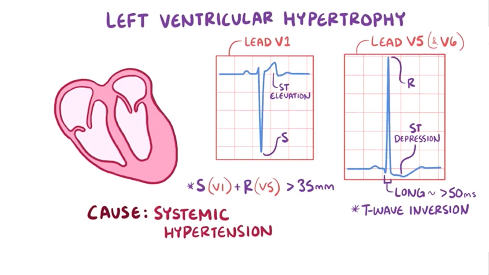 EKG DERS 7; HIPERTROFI ve GENISLEME