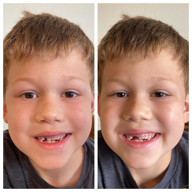 Tales of the Flowers: Ian loses his 6th tooth! 2021-04-20