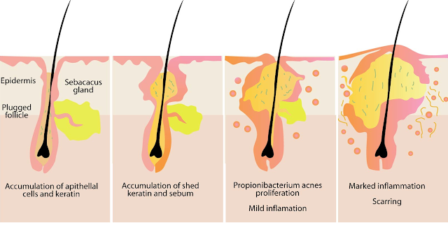You may have acne, but do you know which TYPE? | McLean & Potomac ...