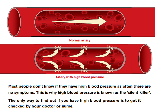 High Blood Pressure (Hypertension) | Medical Notes