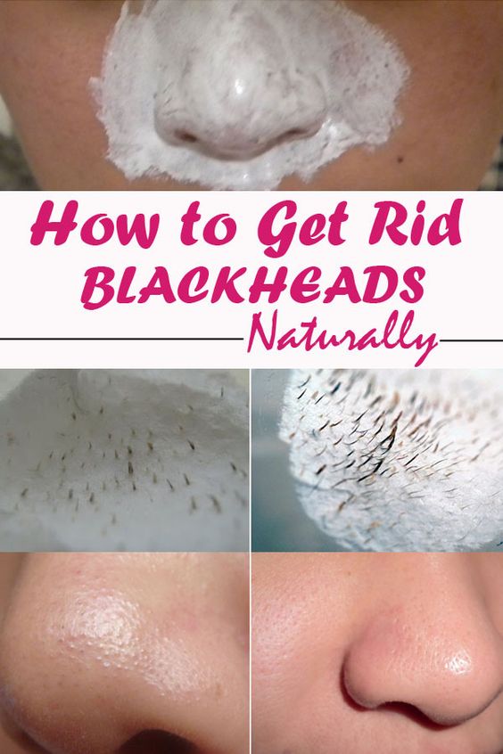 Blackhead Remover Best Natural Ways To Remove Blackhead For Good