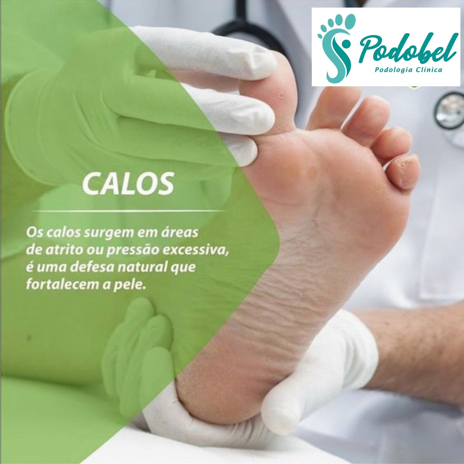 Podobel - Podologia Clínica: CALOS E CALOSIDADES