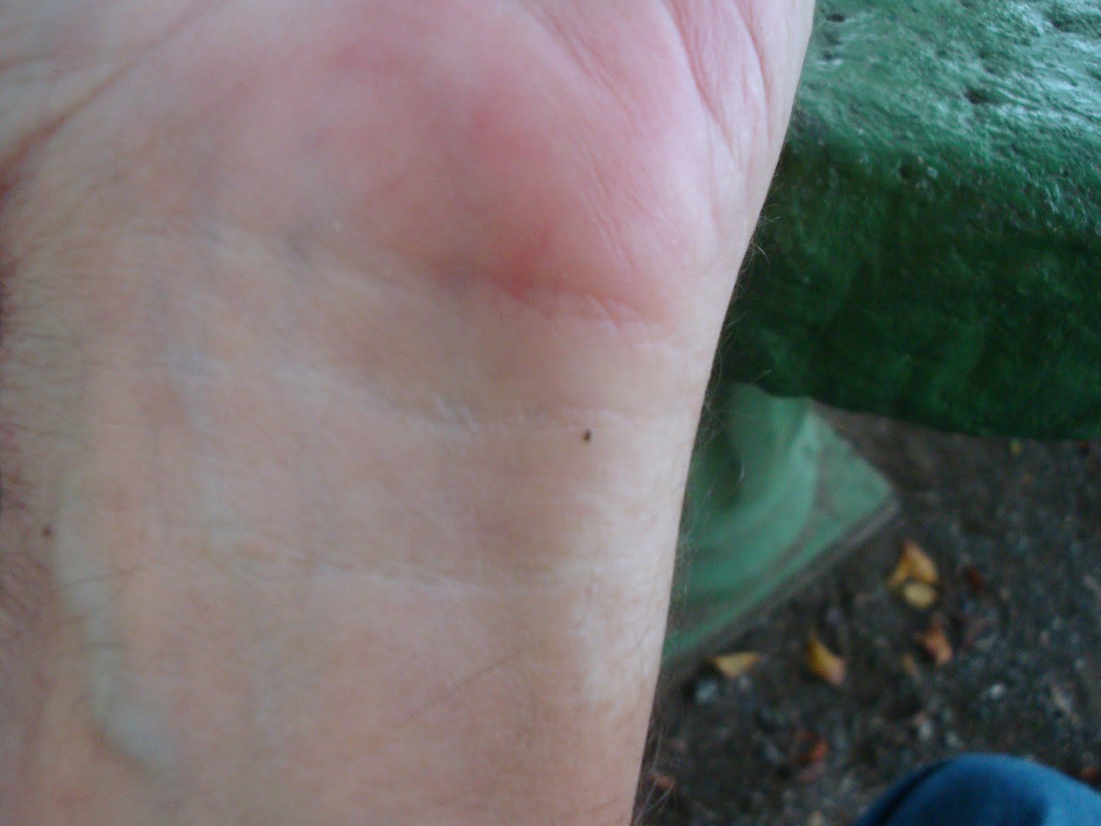 stephen fry depression: La purruja y sus dichosas picaduras