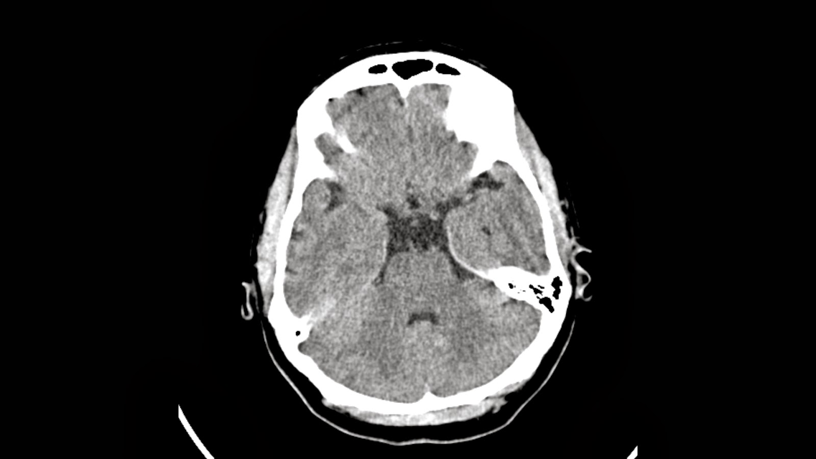 Ultimate Radiology : Fetal PCA