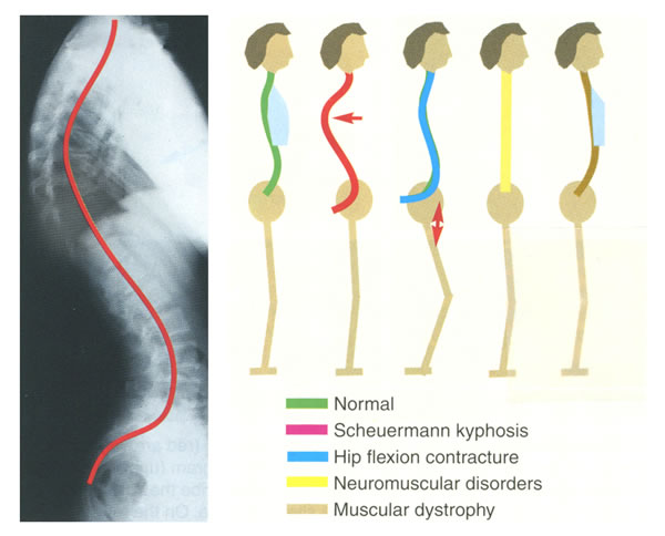 What is Kyphosis ??? | Just For Musculoskeletal